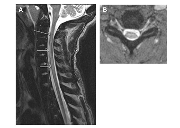A 19-year-old man with sickle cell disease presenting with spinal ...